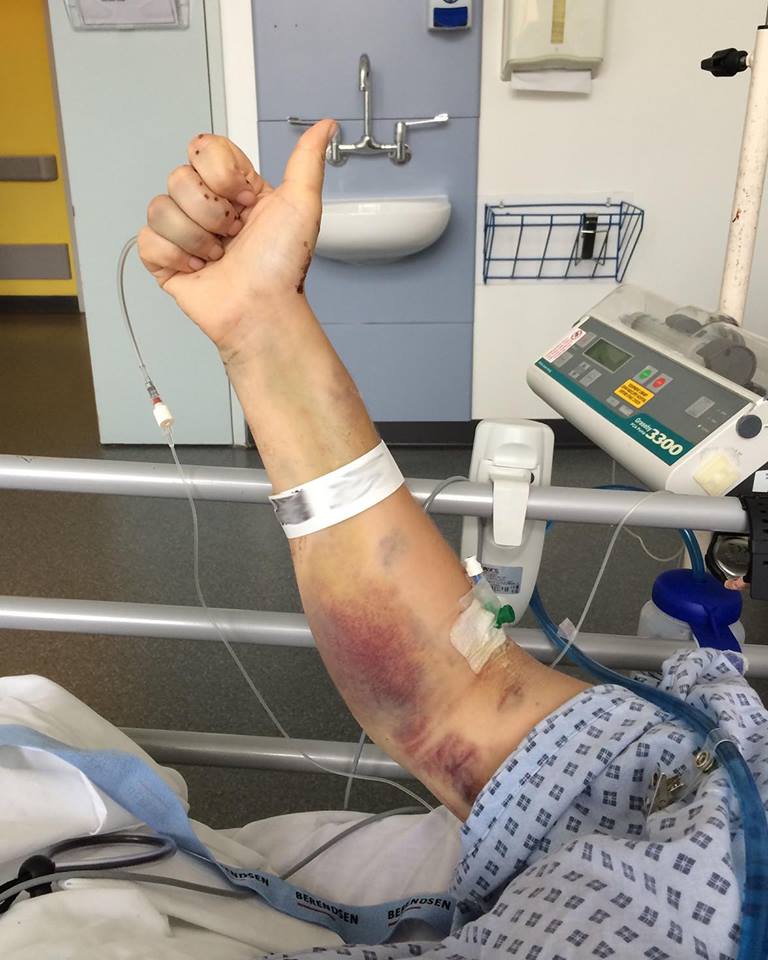 And so it begins… – Life After Limb